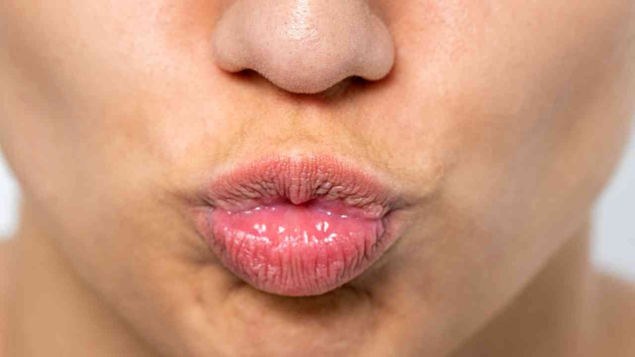 Kiss Off! How to Get Rid of Blackheads on Lip and Mouth!