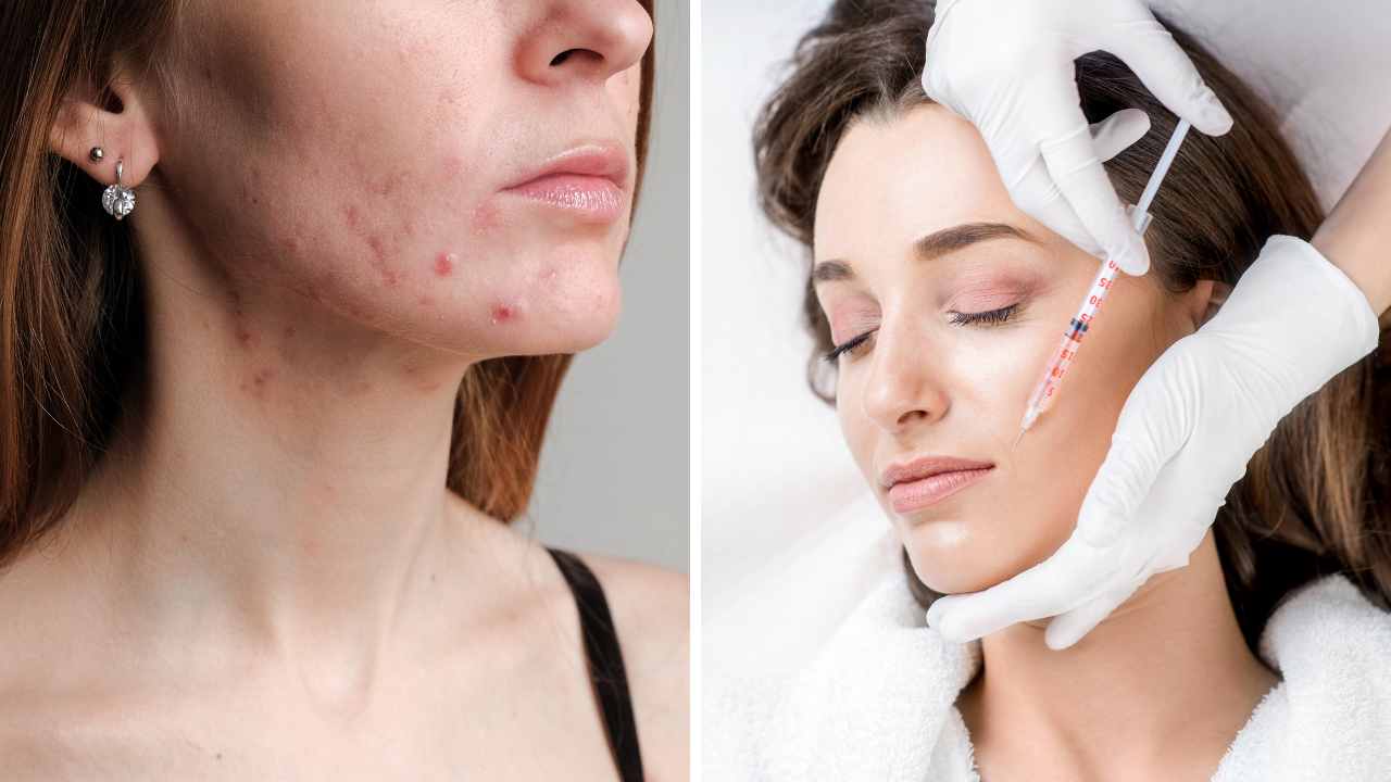 Botox Beyond Wrinkles: Does Botox Help Acne?