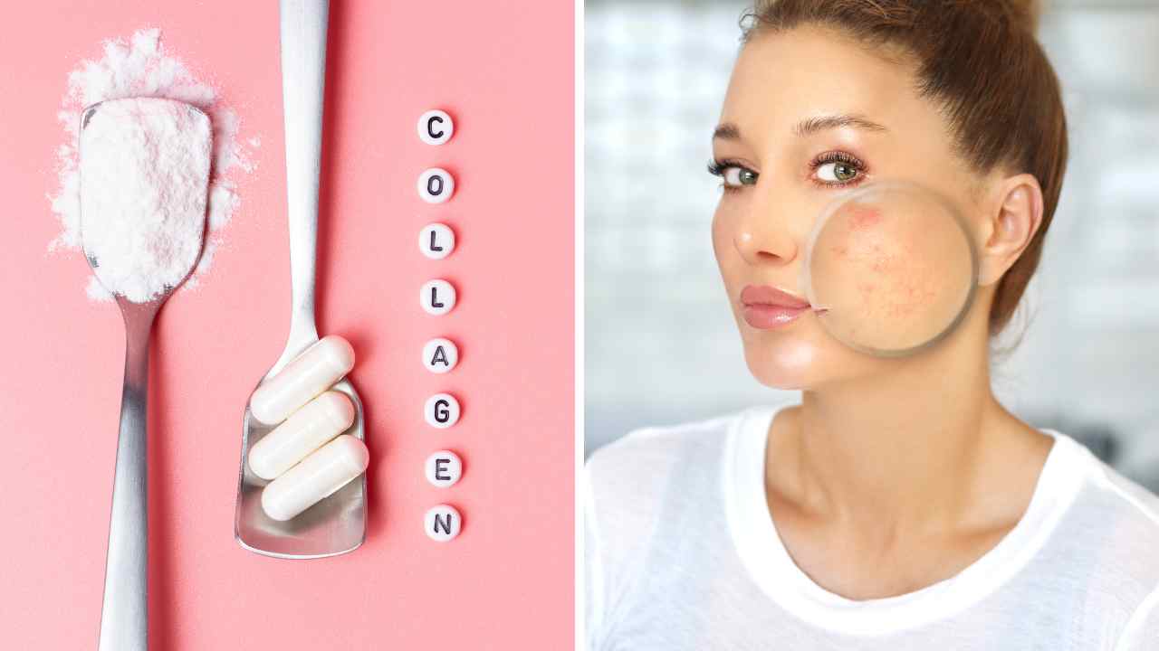 Can Collagen Cause Acne? What the Science Says!