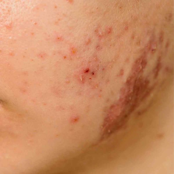 Vaping and Skin Health: Can Vaping Cause Acne Breakouts?