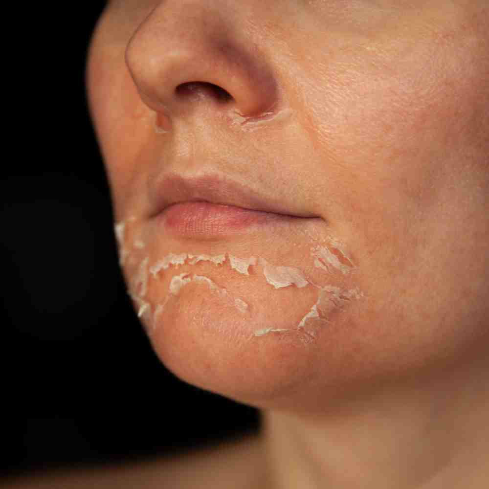 What Is a Phenol Peel & Is It As Dangerous As It Looks?